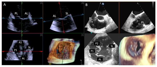 Early Experience with Acuson AcuNav 4D-ICE to Guide Transcatheter ...