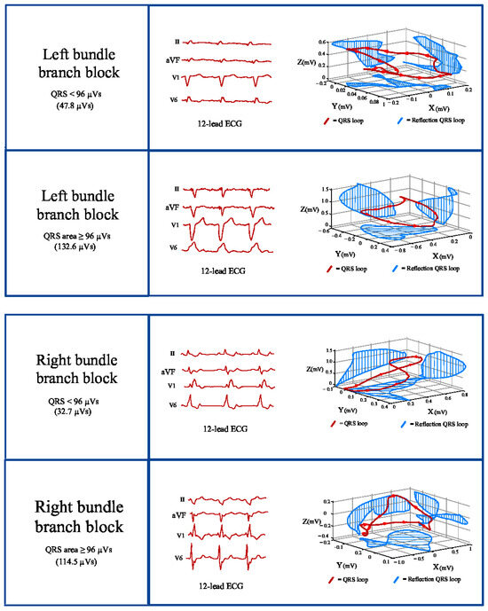 Vectorcardiography in CRT: What We Know and What There Is to Learn
