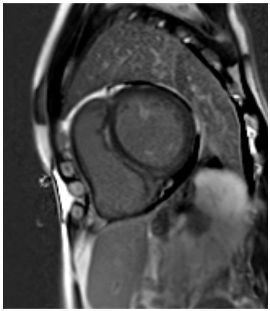 Cardiac Magnetic Resonance in Heart Failure: Diagnostic and Prognostic ...