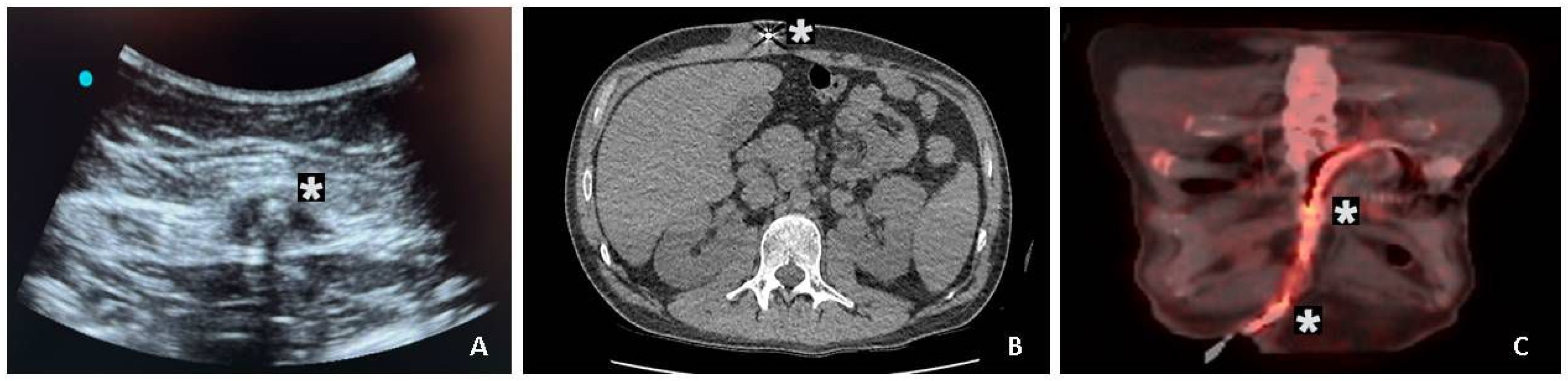 Driveline Relocation and Vacuum-Assisted Closure for Ventricular Assist ...