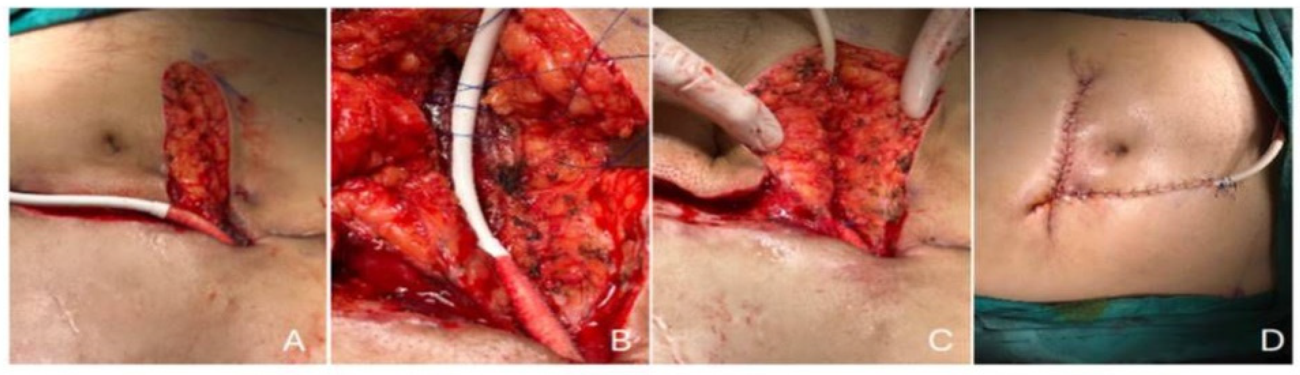 Driveline Relocation and Vacuum-Assisted Closure for Ventricular Assist ...