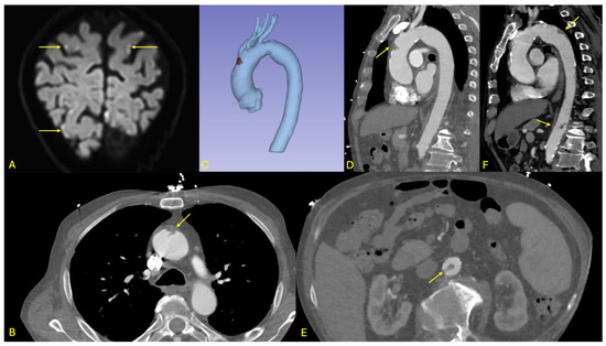 Floating Thrombus on the Ascending Aorta and/or Aortic Arch, to Operate ...