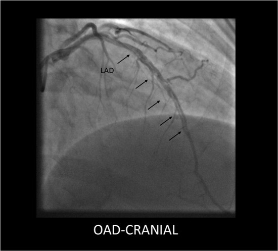 Spontaneous Coronary Artery Dissection Unveiled: Pathophysiology ...