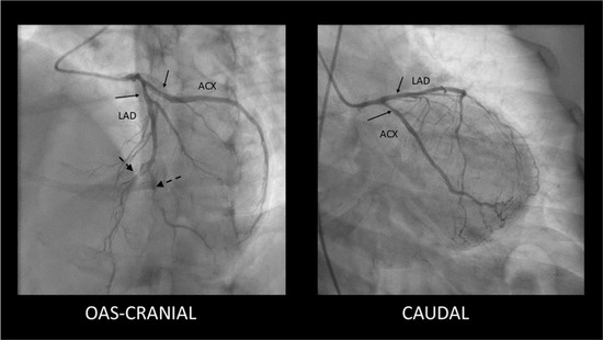 Spontaneous Coronary Artery Dissection Unveiled: Pathophysiology ...