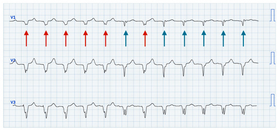 Double QRS Transition Due to Anodal Capture During Left Bundle Branch ...