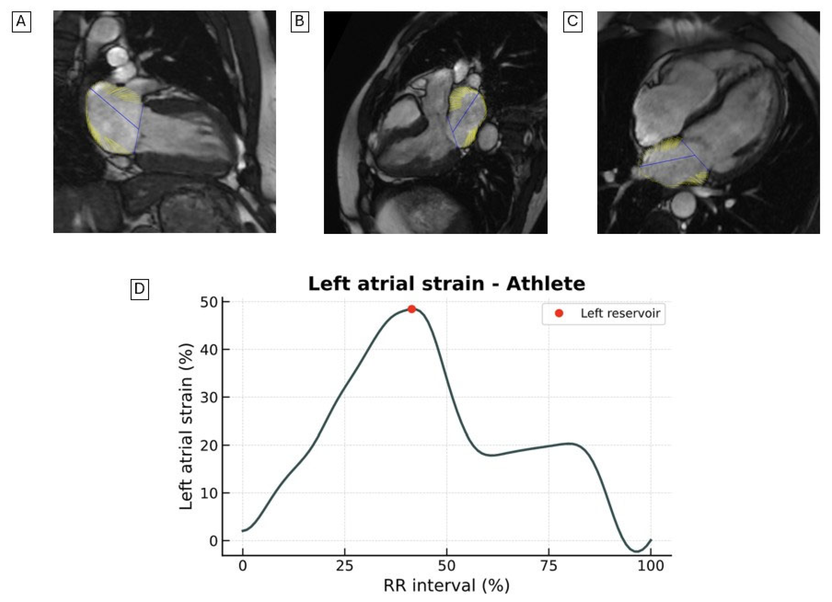 Comprehensive Assessment of Left Atrial Function: The Emerging Role of ...