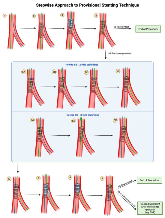 Coronary Bifurcation PCI—Part I: Fundamentals