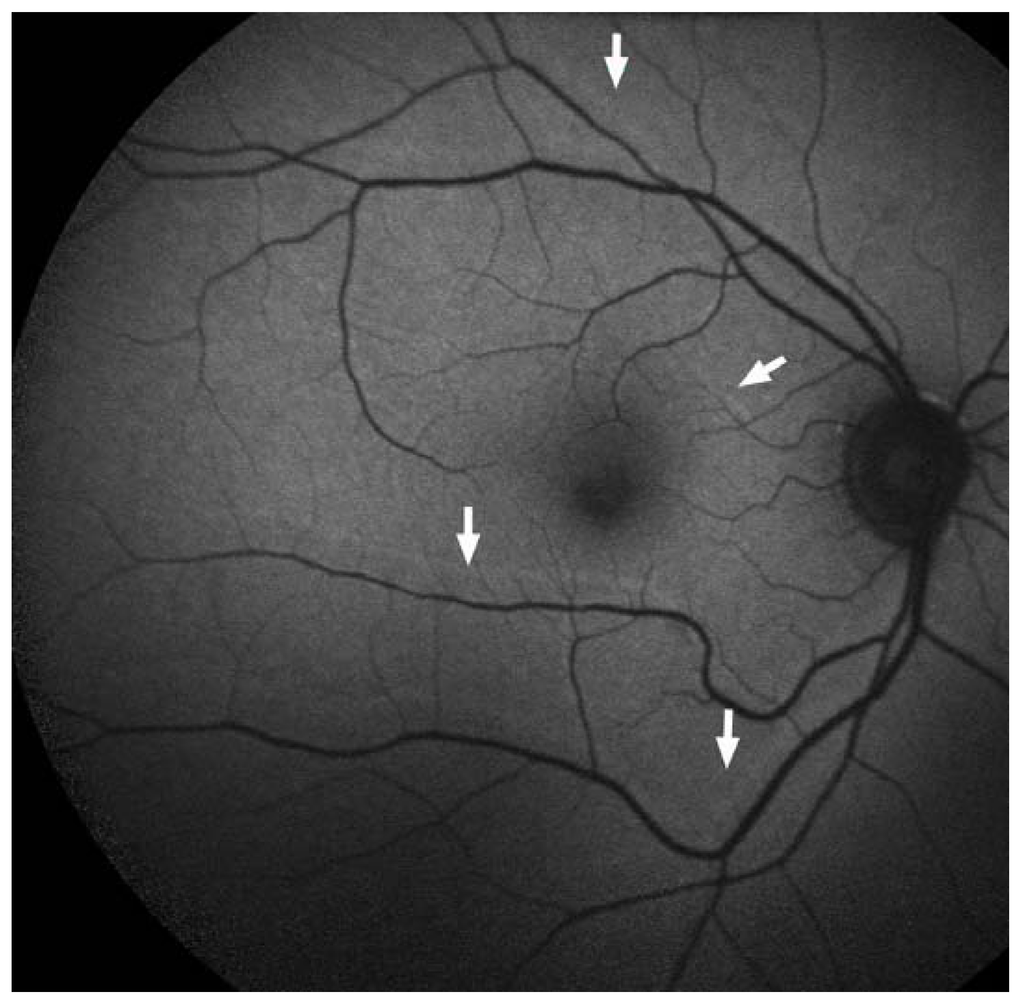 JCM | Free Full-Text | Fundus Autofluorescence and RPE Lipofuscin in ...
