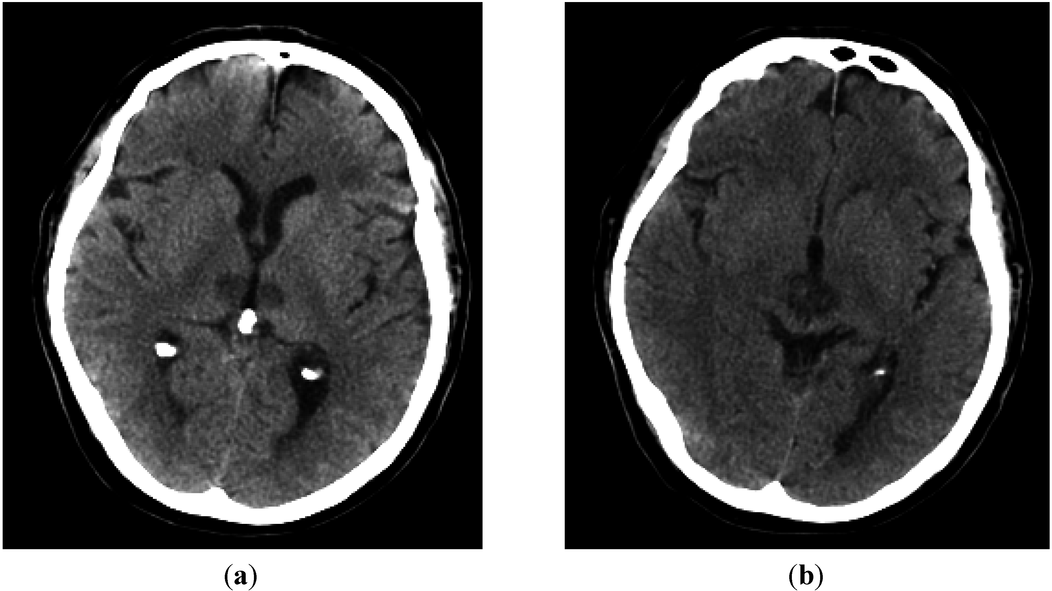 Midbrain Ct