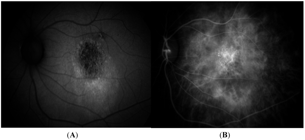 Polypoidal Choroidal Vasculopathy in Asians