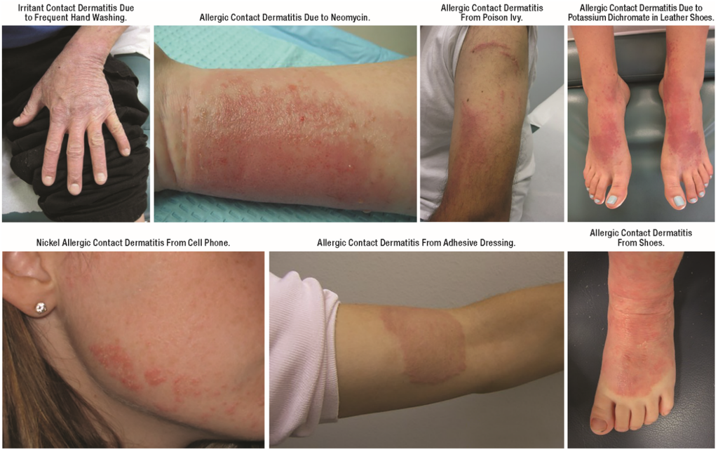 Contact Dermatitis Chest