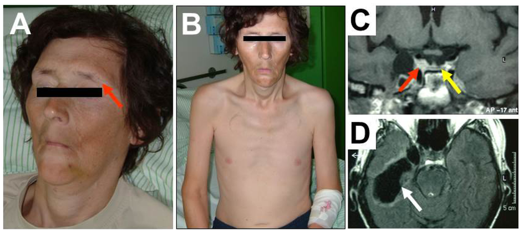 Addisonian Crisis after Missed Diagnosis of Posttraumatic Hypopituitarism Addisonian Crisis after Missed Diagnosis of Posttraumatic Hypopituitarism