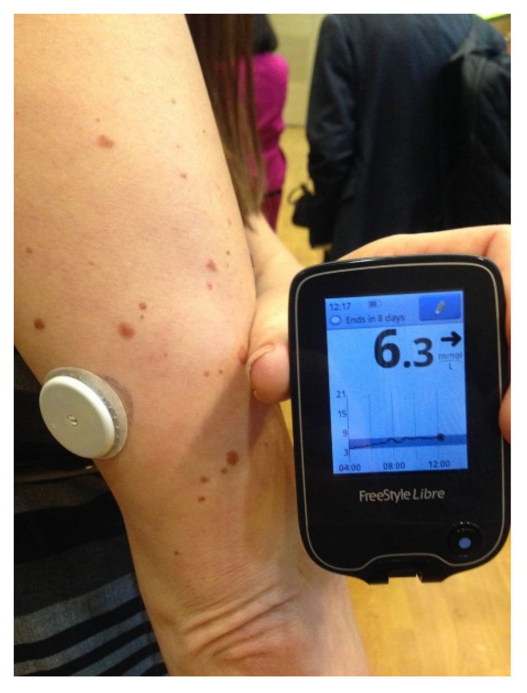 An Overview of Insulin Pumps and Glucose Sensors for the Generalist