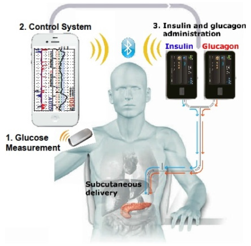 An Overview of Insulin Pumps and Glucose Sensors for the Generalist