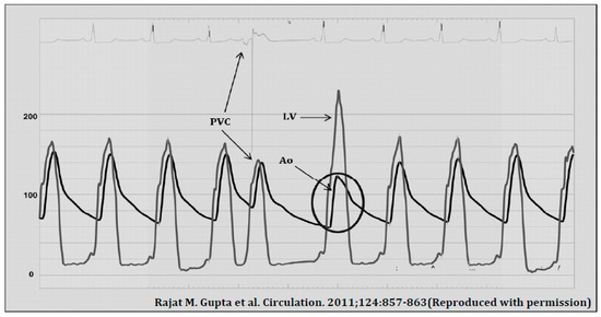 JCM | Free Full-Text | Hypertrophic Cardiomyopathy—Past, Present and Future