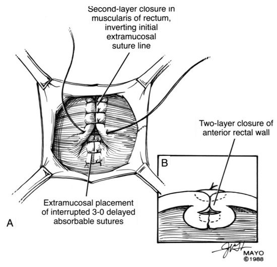 Jcm Free Full Text Colorectal Vaginal Fistulas Imaging And Novel