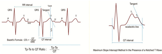 Elevated LV Mass and LV Mass Index Sign on the Athlete’s ECG: Athletes ...