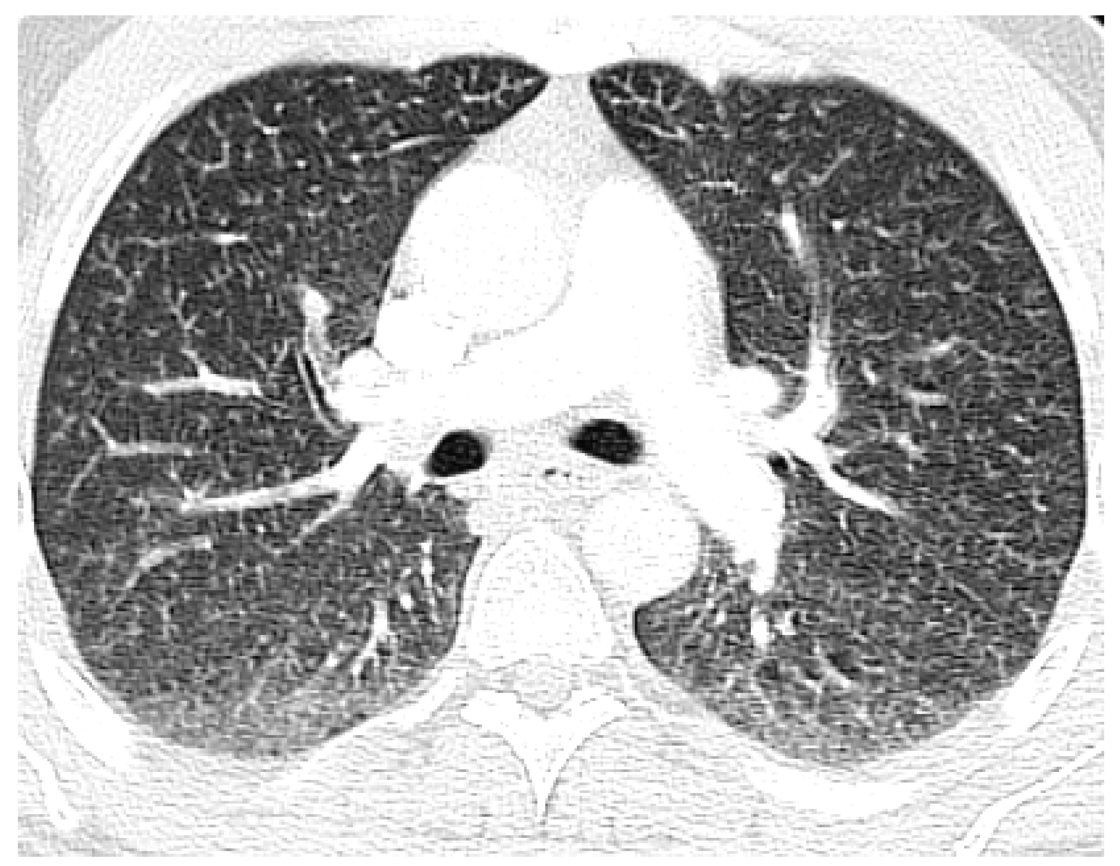 An Unusual and Fatal Cause of Miliary Nodules on Chest Radiography