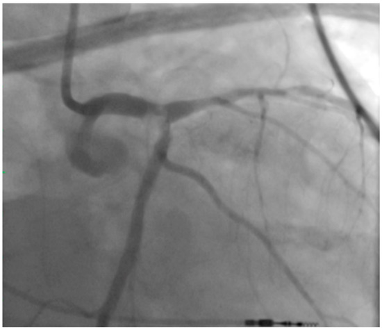 Percutaneous Left Main Coronary Intervention: A Review of Plaque ...