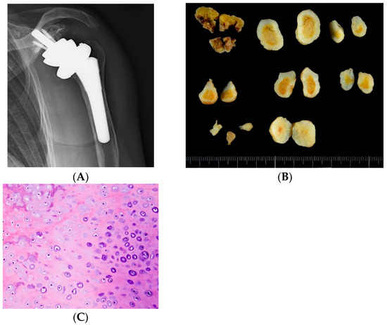 Reverse Shoulder Arthroplasty for Primary Synovial Osteochondromatosis ...