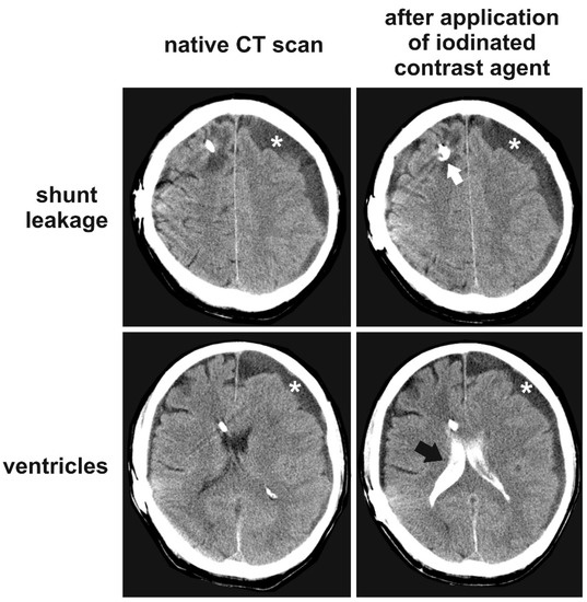 Ventriculoperitoneal Shunts Equipped with On-Off Valves for ...