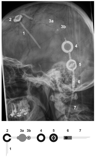 Ventriculoperitoneal Shunts Equipped with On-Off Valves for ...