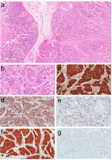 The Diagnosis and Clinical Significance of Paragangliomas in Unusual ...
