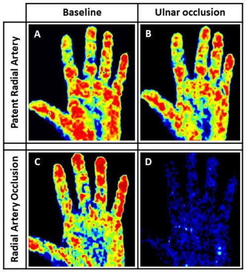 Hand Laser Perfusion Imaging to Assess Radial Artery Patency: A Pilot Study