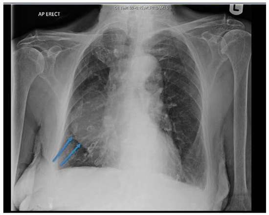 Pericardial Cyst: Never Too Late to Diagnose