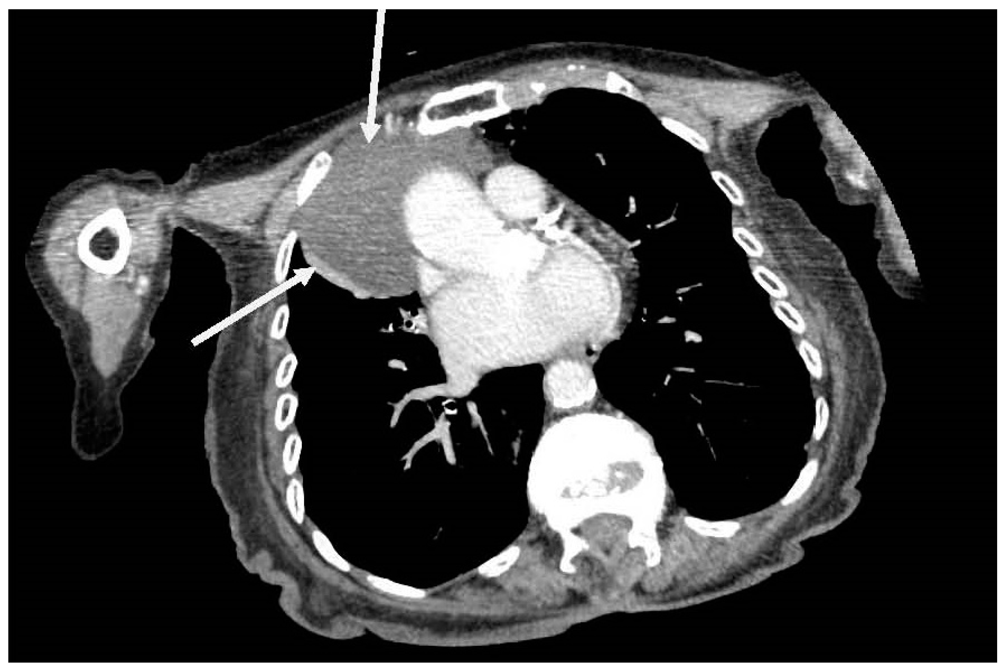 Pericardial Cyst: Never Too Late to Diagnose