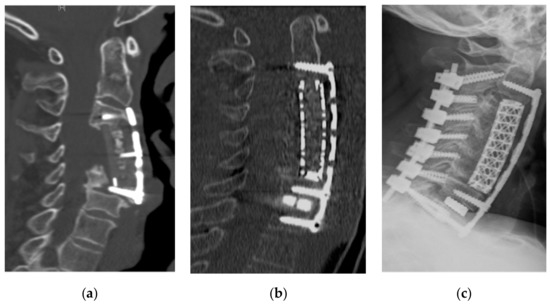Jcm Free Full Text Radiological And Clinical Outcome After Multilevel Anterior Cervical