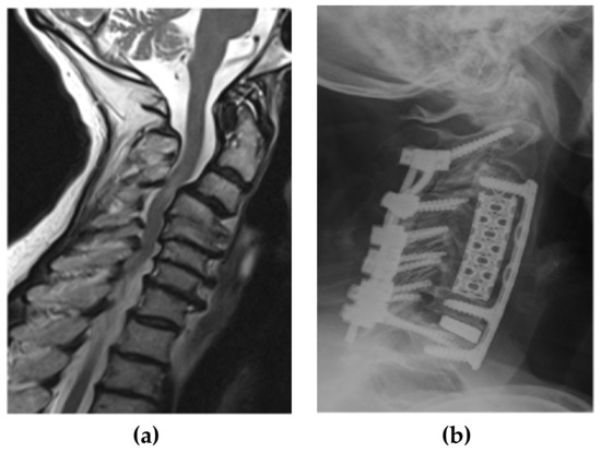 Radiological and Clinical Outcome after Multilevel Anterior Cervical ...