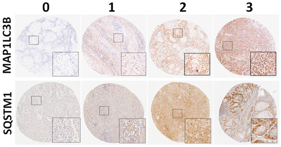 Map1lc3b and Sqstm1 Modulated Autophagy for Tumorigenesis and Prognosis ...