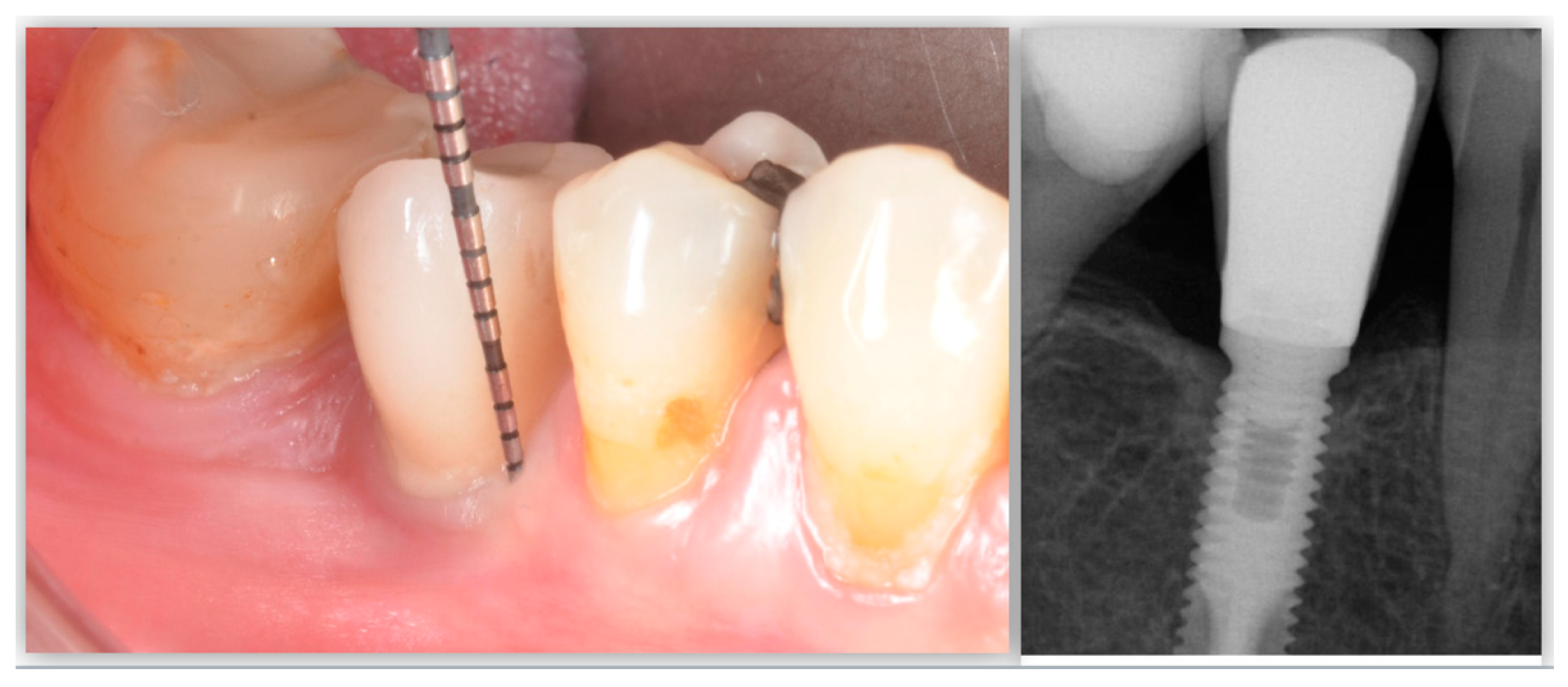 Understanding Peri-Implantitis as a Plaque-Associated and Site-Specific ...
