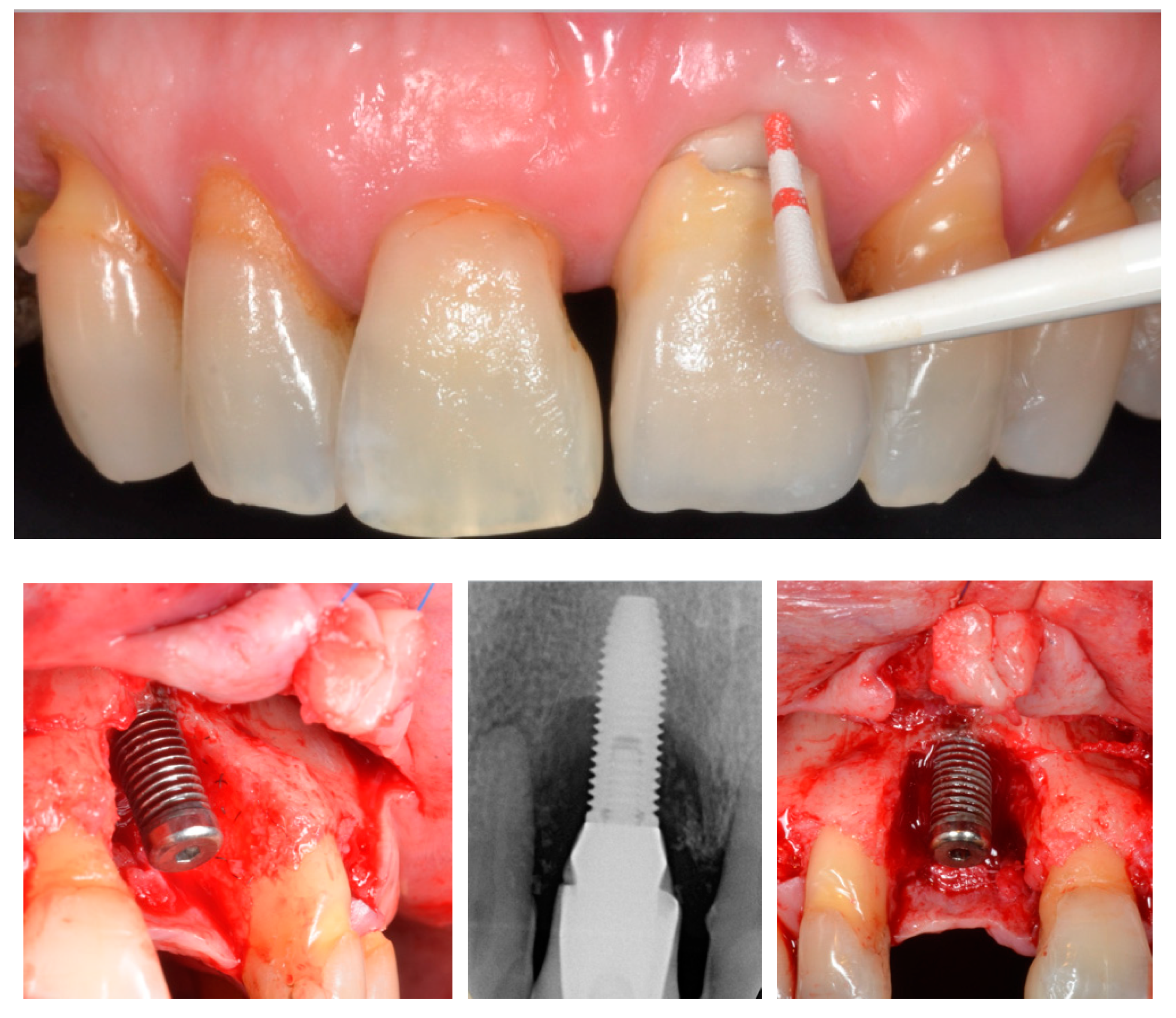 Understanding Peri-Implantitis as a Plaque-Associated and Site-Specific ...