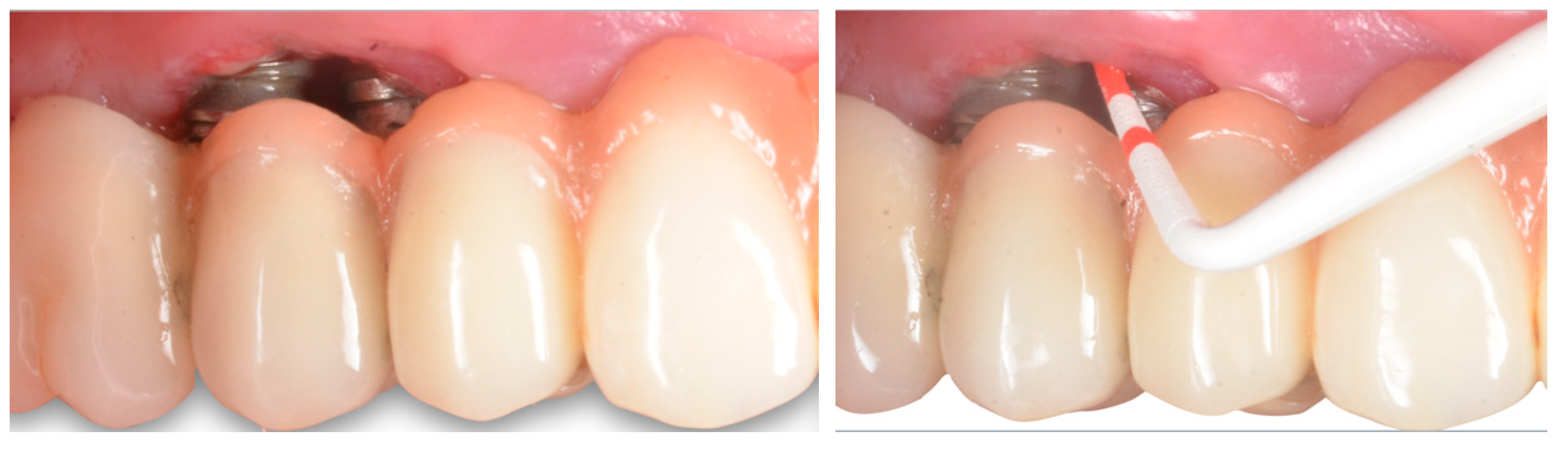 Understanding Peri-Implantitis as a Plaque-Associated and Site-Specific ...