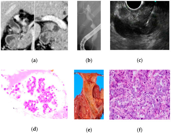 Endoscopic Ultrasonography-Guided Fine Needle Aspiration for ...