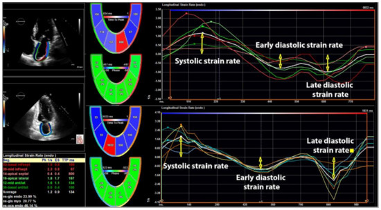 Phasic Left Atrial Function in Cancer Patients Before Initiation of ...