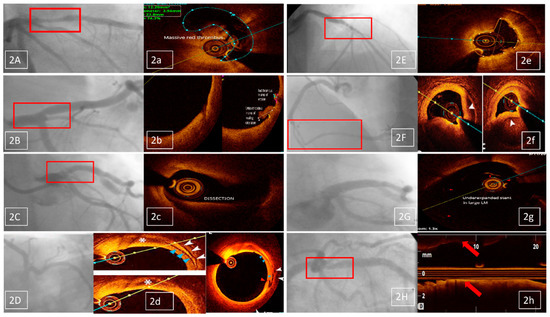 Real-Life Benefit of OCT Imaging for Optimizing PCI Indications ...