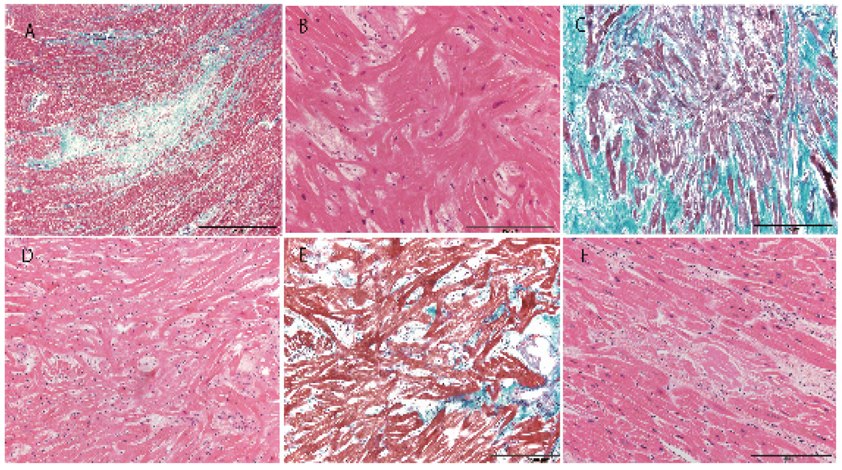 Clinicopathological and Genetic Profiles of Cases with Myocyte Disarray ...