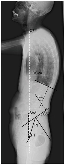 Factors Predicting the Surgical Risk of Osteoporotic Vertebral ...