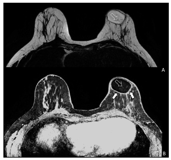 Engineered Fat Graft Enhanced with Adipose-Derived Stromal Vascular ...