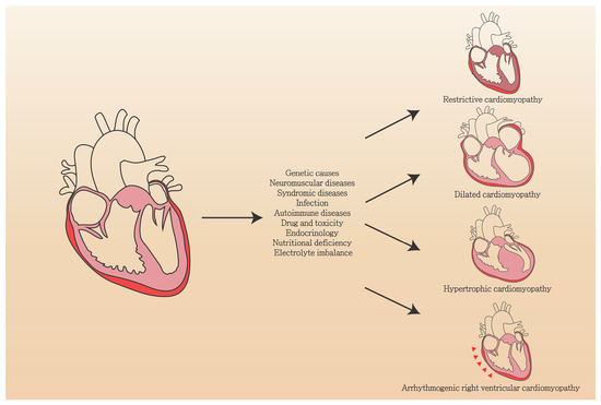 Advanced Evolution of Pathogenesis Concepts in Cardiomyopathies