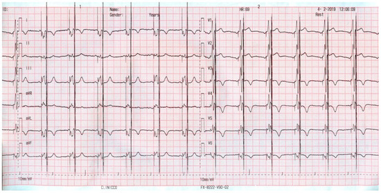 New Generation Cardiac Contractility Modulation Device—Filling the Gap ...