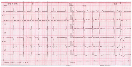 New Generation Cardiac Contractility Modulation Device—Filling the Gap ...