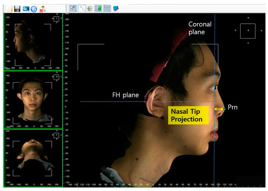 Long-Term Nasal Growth after Primary Rhinoplasty for Bilateral Cleft ...