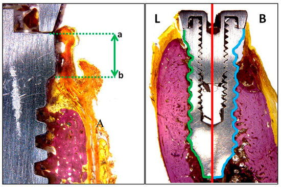 Can the Macrogeometry of Dental Implants Influence Guided Bone ...