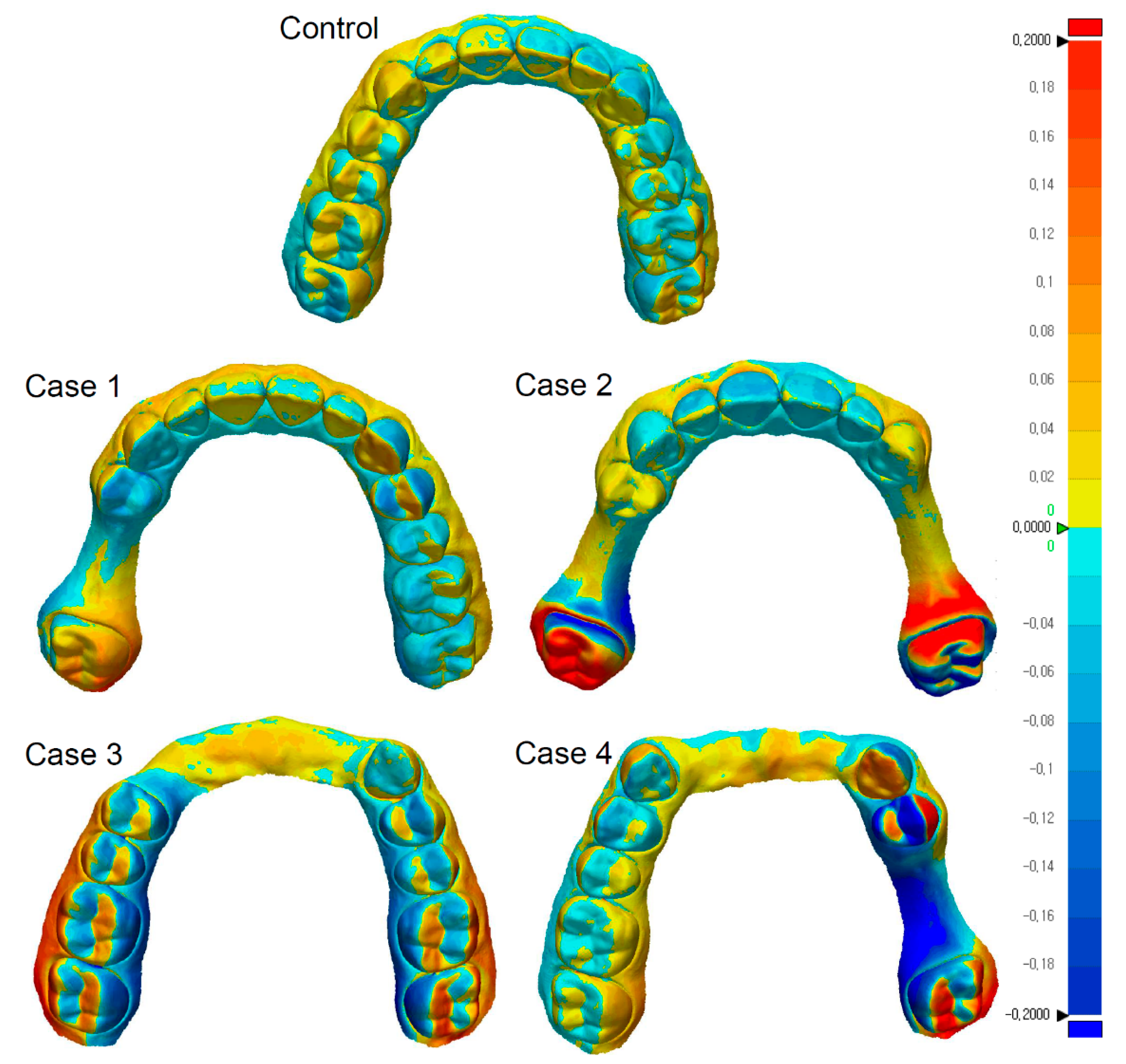 Repeatability of Intraoral Scanners for Complete Arch Scan of Partially ...