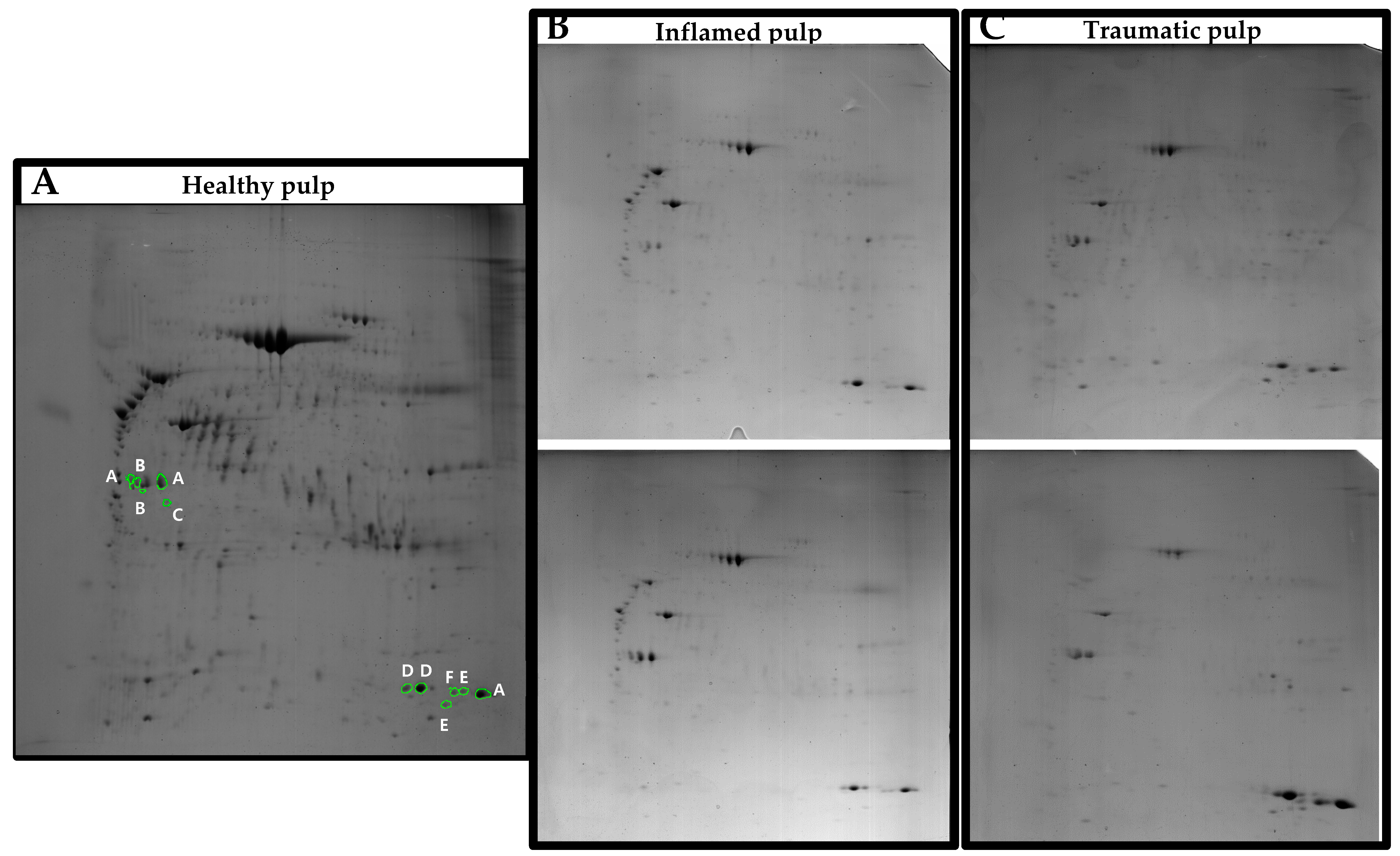Differential Protein Expression in Human Dental Pulp: Comparison of ...