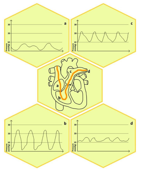 Right Heart Catheterization—Background, Physiological Basics, and ...